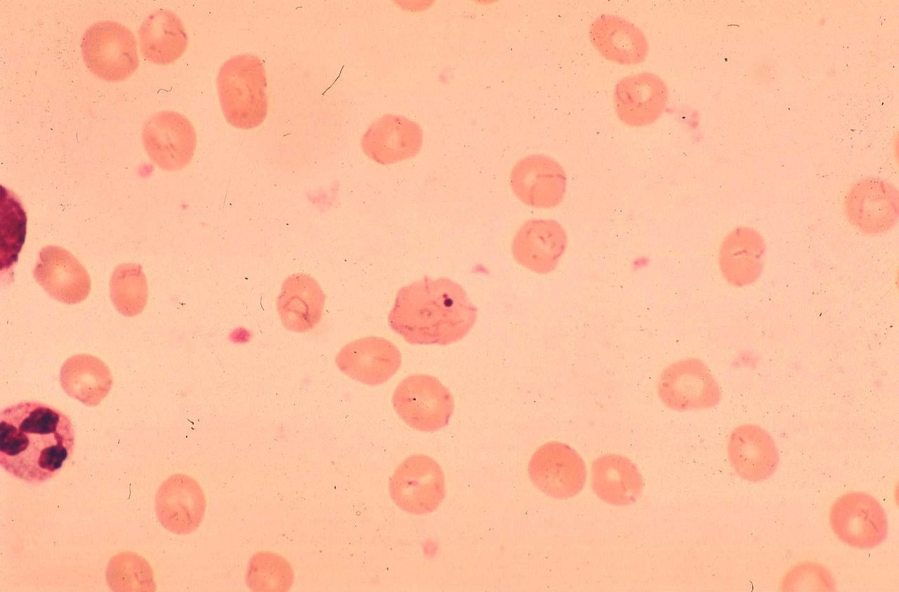 Carrion's Disease Treatment - Stem Cells Treatment Clinic | Swiss Medica