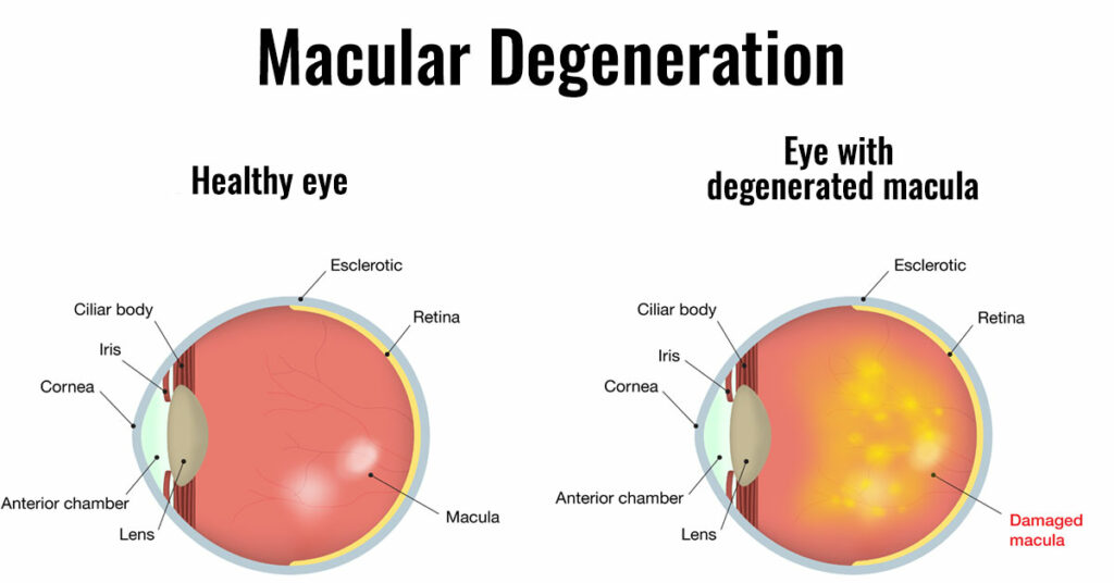 Macular Degeneration Treatment with Stem Cells | Swiss Medica