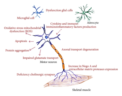 The Stages of ALS: Understanding the Progression of the Disease | Swiss ...