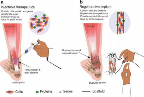 Stem cell therapies tendon repair | Swiss Medica