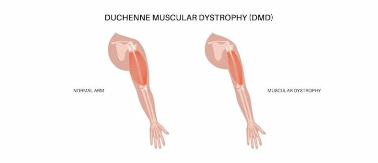 Stem Cell Therapy For Duchenne Muscle Dystrophy | Swiss Medica