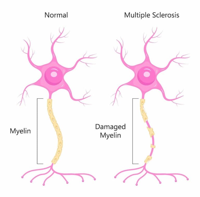 Early Symptoms Of Multiple Sclerosis In Women You Need To Know | Swiss ...