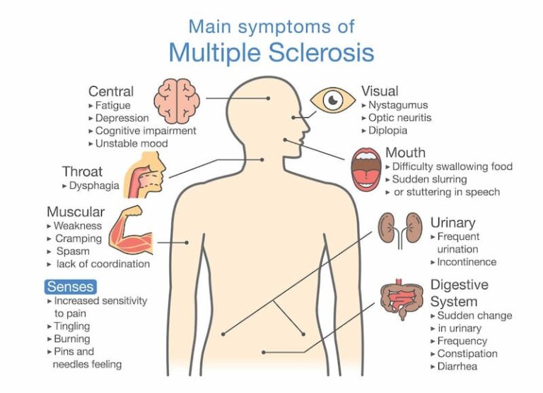 Early Symptoms Of Multiple Sclerosis In Women You Need To Know | Swiss ...