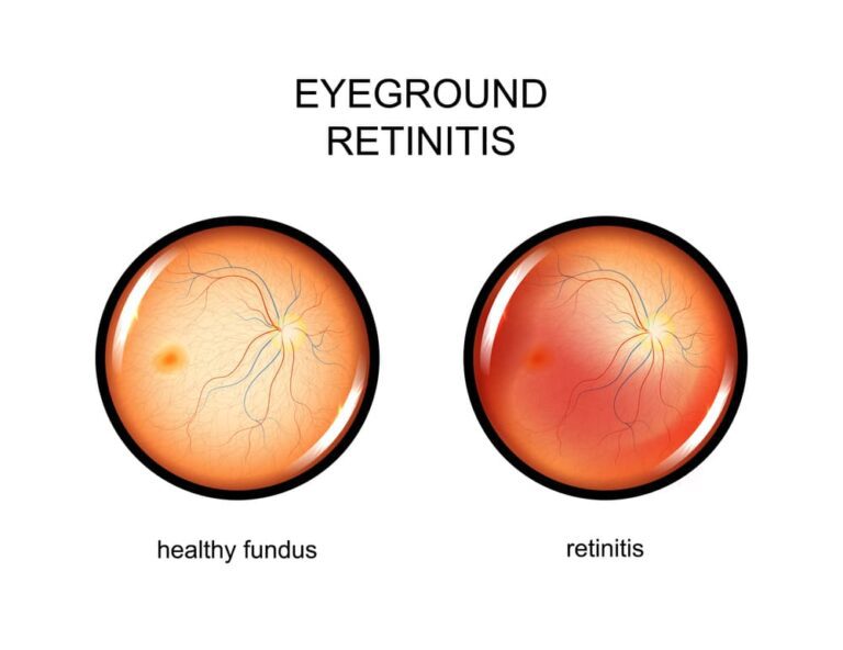 Stem Cell Therapy for Retinitis/Retinopathy | Swiss Medica