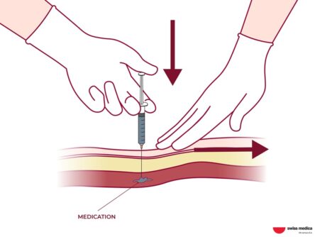 Breakthrough Stem Cell Therapy for Lyme Disease | Swiss Medica