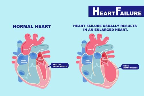 Stem Cell Therapy for Heart Failure | Swiss Medica